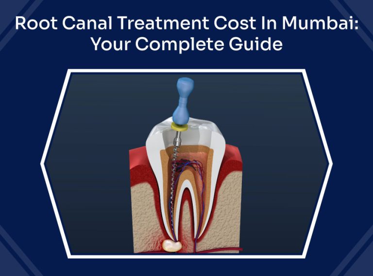 Root Canal Treatment Cost In Mumbai: Your Complete Guide