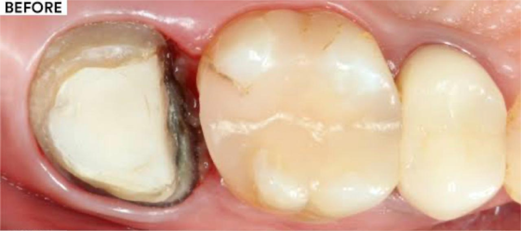 Painless Root Canal Treatment in Vile Parle East, Mumbai