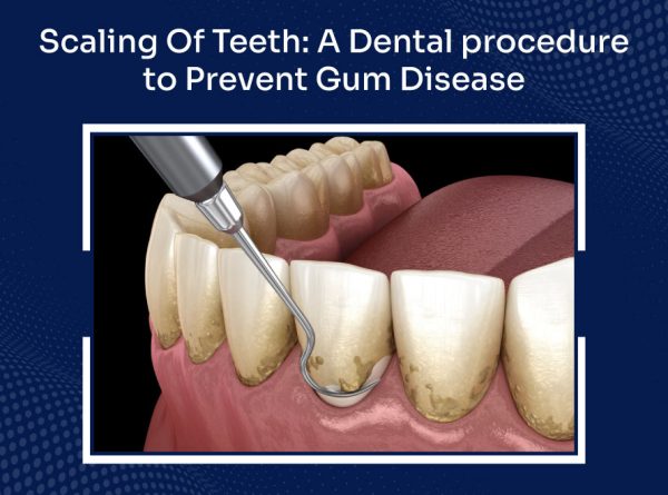Scaling of Teeth: A Dental Procedure to Prevent Gum Disease